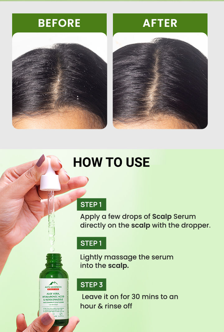 Alps Goodness Aloe Vera, Hyaluronic Acid & Ketoconazole Anti Dandruff Scalp Serum For Dry Scalp ...